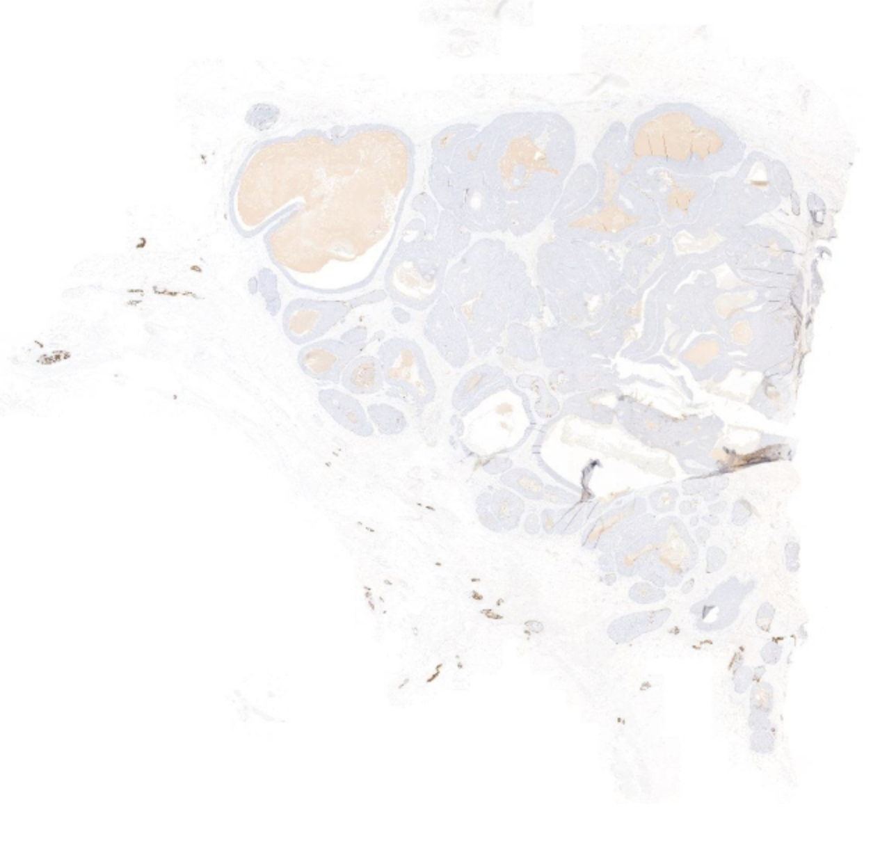 Case 10g – CK5-6 | Nottingham and Singapore Breast Pathology Online ...