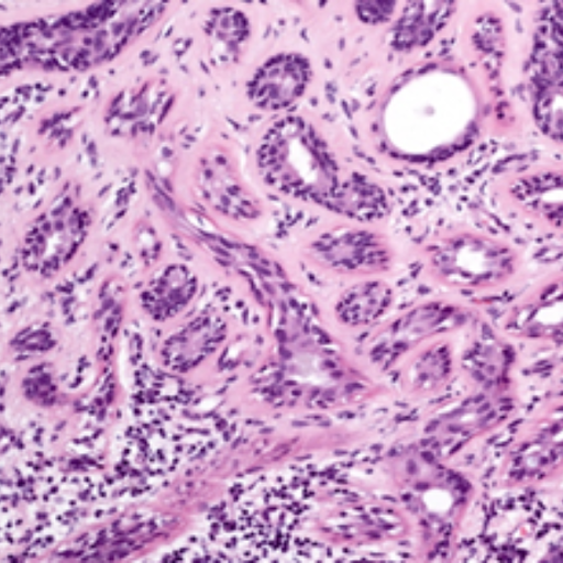 Nottingham and Singapore Breast Pathology Online Masterclass | Updates ...